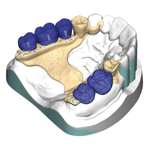 exocad tooth library ZRS module - Bristol CadCam