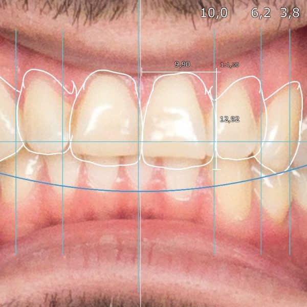exocad tooth library ZRS module - Bristol CadCam